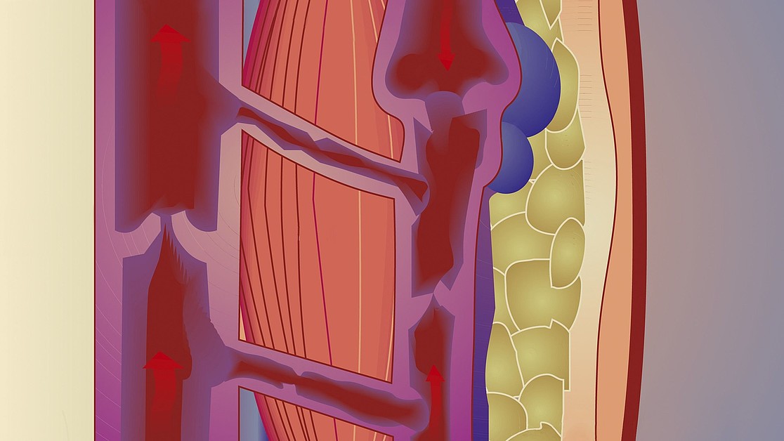 Varicose veins (varicosity, varices)